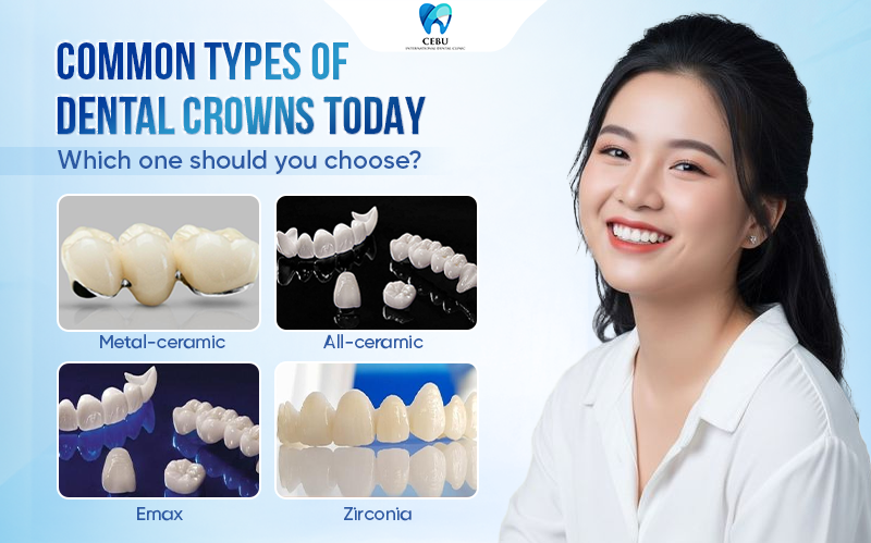COMMON TYPES OF DENTAL CROWNS TODAY